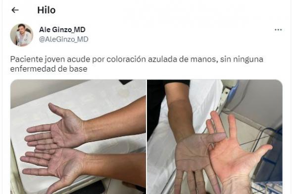 Un médico impresiona al contar el caso de las 'manos azules' con el ...