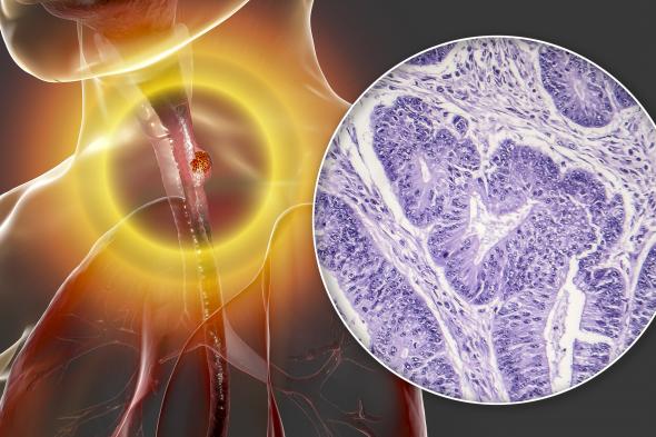 Investigan un nuevo tratamiento para el cáncer de esófago