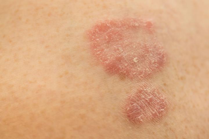 Cómo plantar cara a la psoriasis con nanotecnología