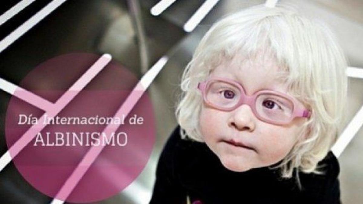 Día Internacional del Albinismo: curiosidades sobre esta alteración ...