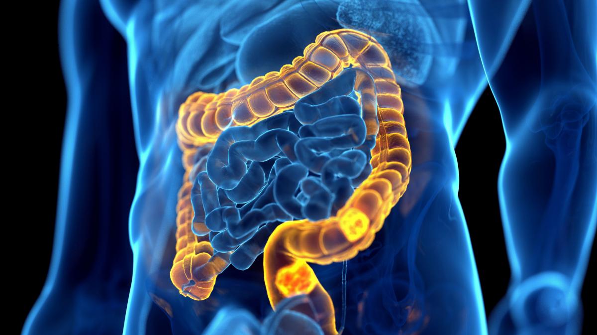 Cáncer de colón: cuál es la enfermedad que mató a Pelé y qué ...