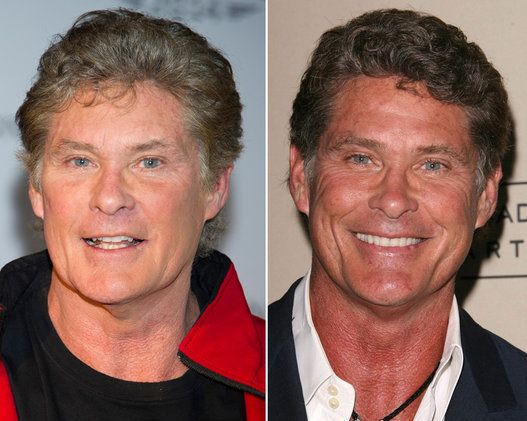 Actores operados: ellos también pasan por el quirófano (FOTOS)