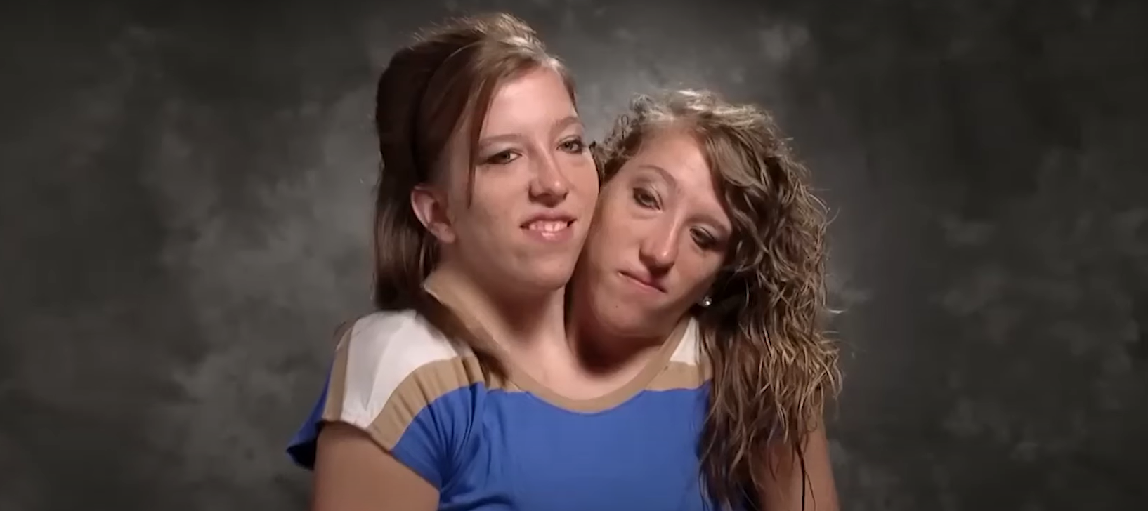 El aspecto de la vida de las siamesas Abby y Brittany que causa ...