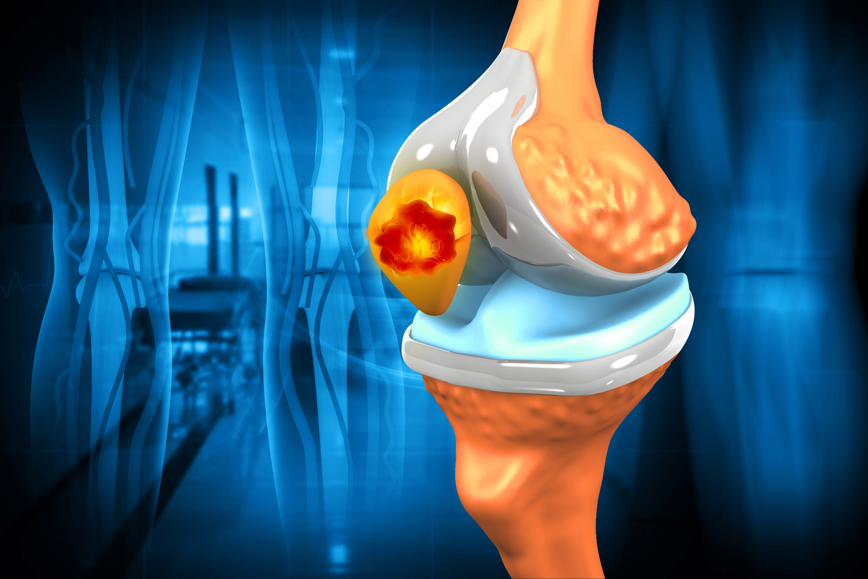Científicos desvelan los factores que impulsan el osteosarcoma, un ...